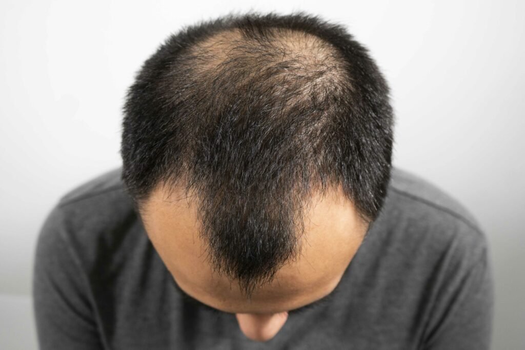Stage 2 Hair Fall: The Ultimate Guide to Understanding, Managing, and ...